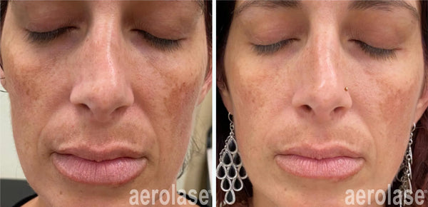 Aerolase Hyperpigmentation & Melasma Treatment | Organico Beauty